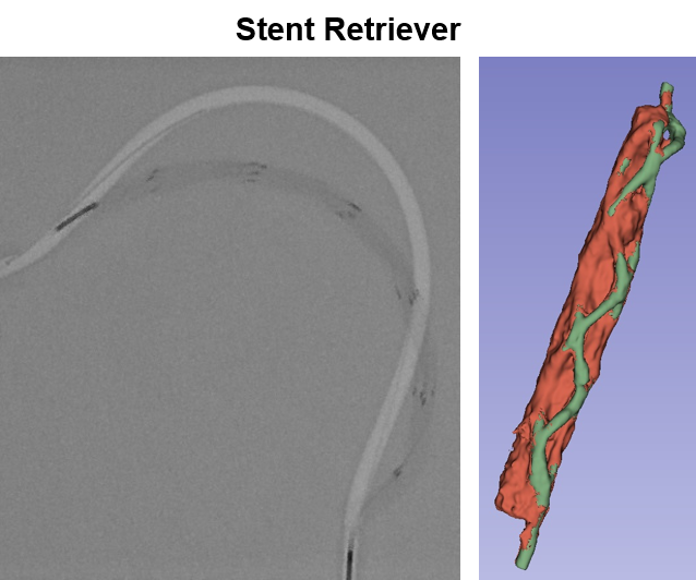 Mechanical Thrombectomy for Ischemic Stroke | Renaissance School of Medicine at Stony Brook ...